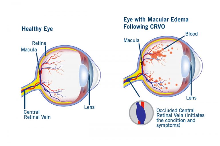 About CRVO – CRVO Survivor's Handbook
